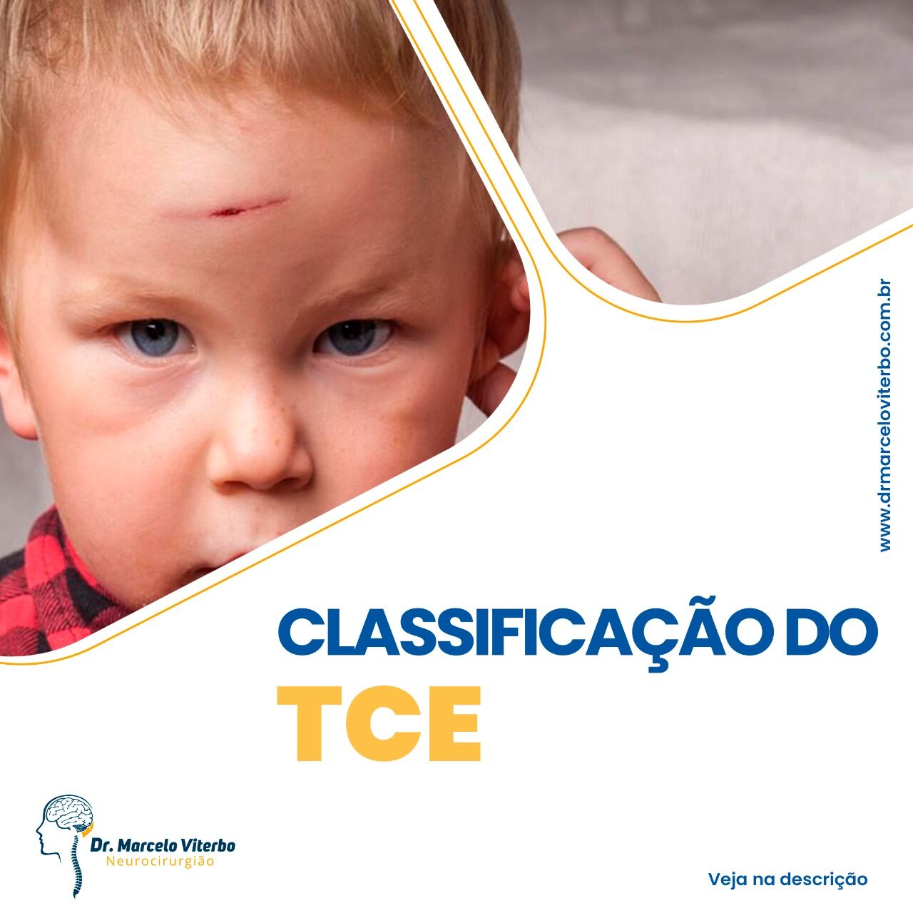 Classificação do Traumatismo Cranioencefálico (TCE) | Dr. Marcelo Viterbo